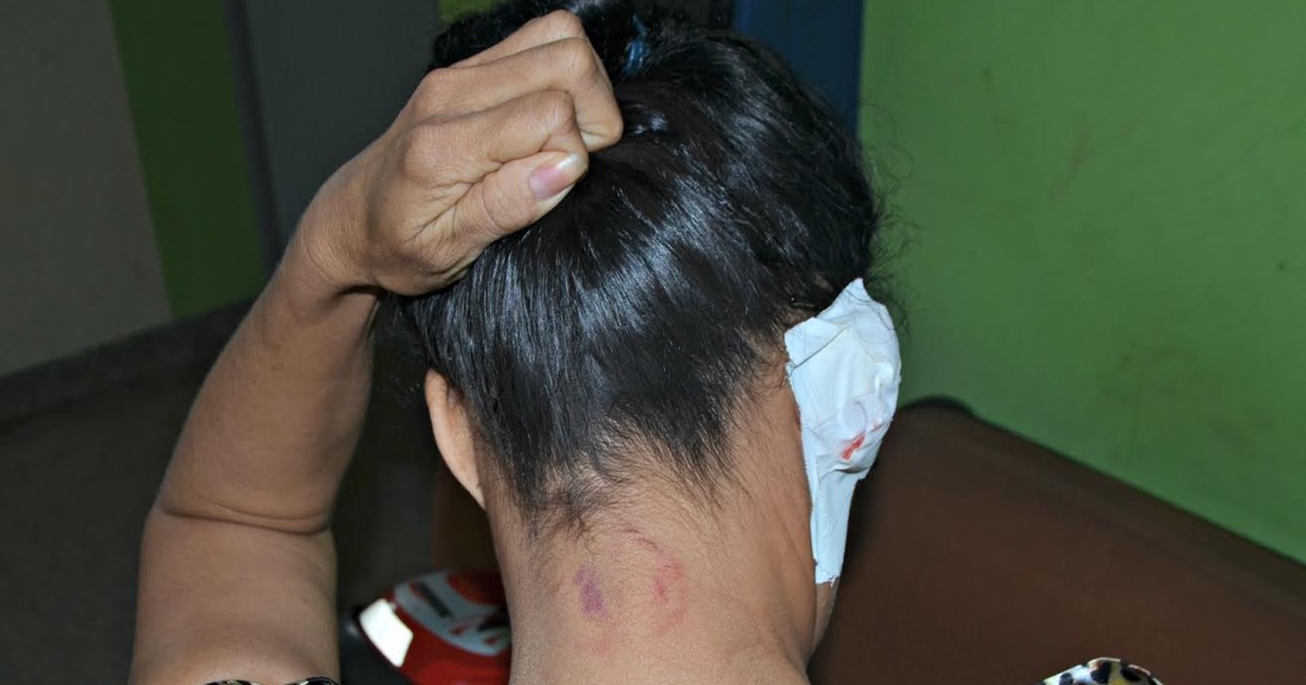 G1 Durante Briga No Ac Mulher Quase Tem Orelha Decepada Por Mordida