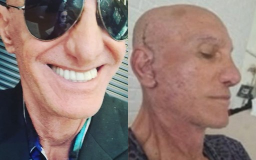 Amin Khader faz nova plástica e não aprova o resultado: "Ficou igual ...