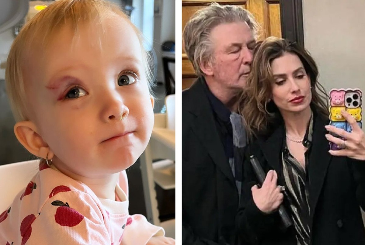 Esposa de Alec Baldwin preocupa fãs ao mostrar olho roxo da filha de um ...