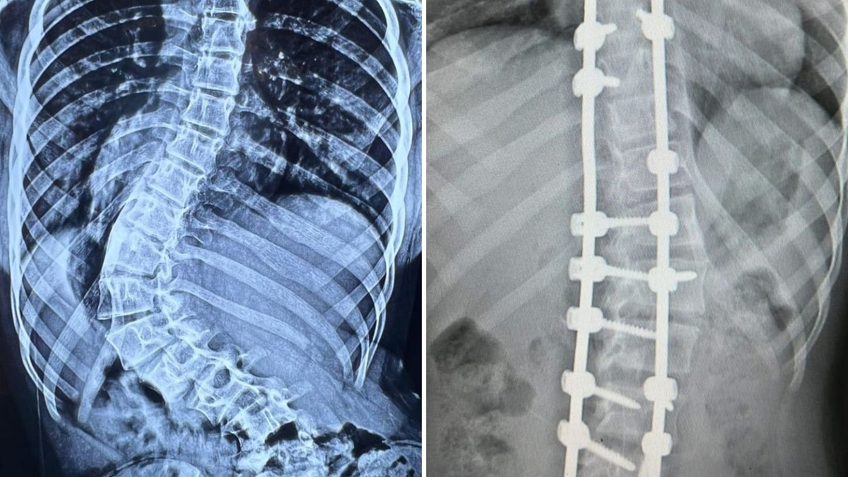 Menina com 'coluna em S' passa por cirurgia de correção da curvatura ...