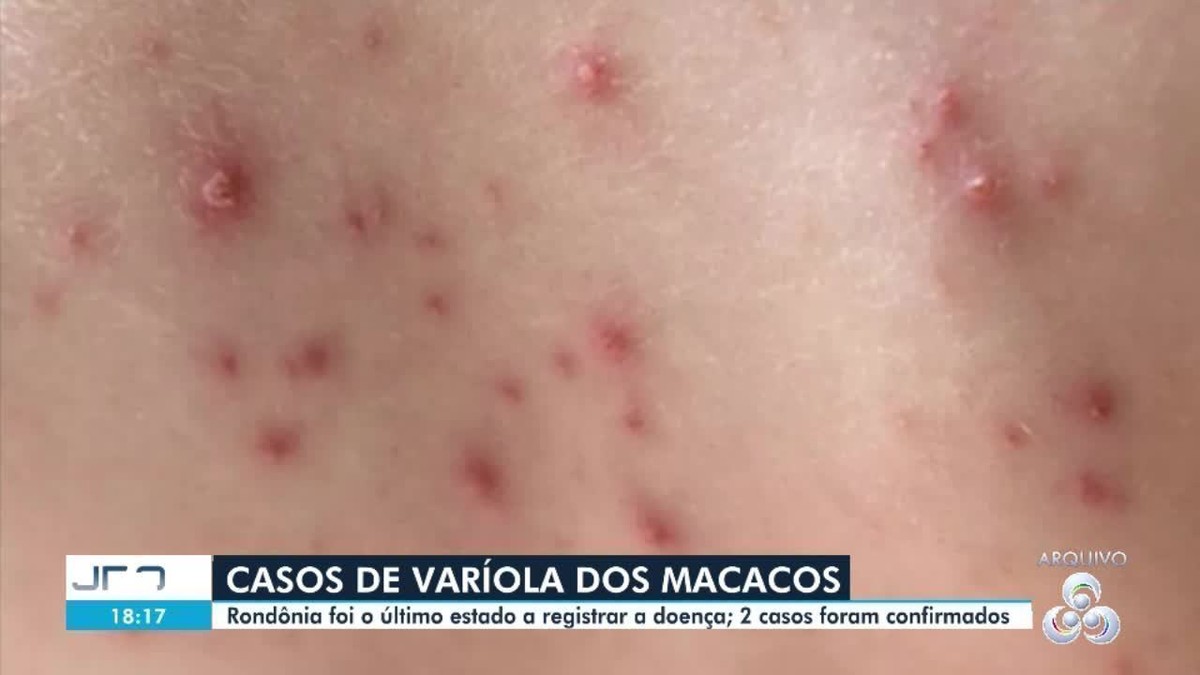 Rondônia tem dois casos confirmados de varíola dos macacos e quatro em ...