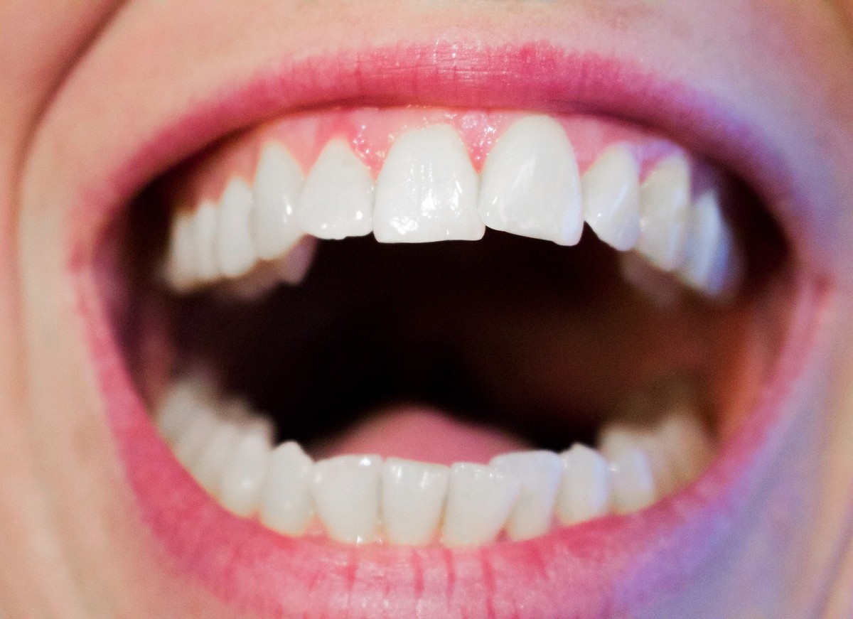 Por que ter dentes brancos não significa necessariamente que estejam ...
