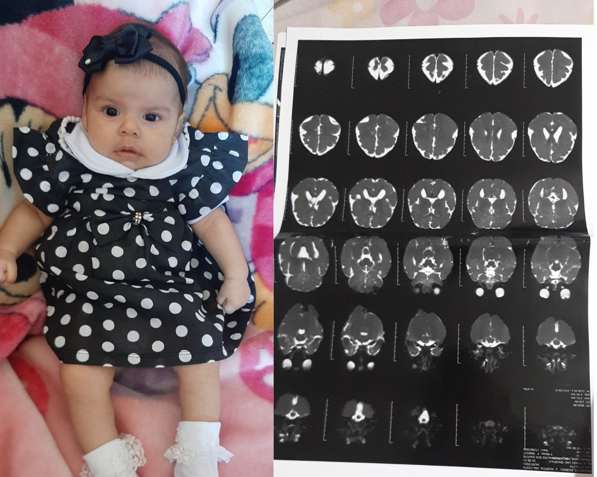 Bebê com síndrome que deixa cérebro 'liso' enfrenta convulsões diárias ...