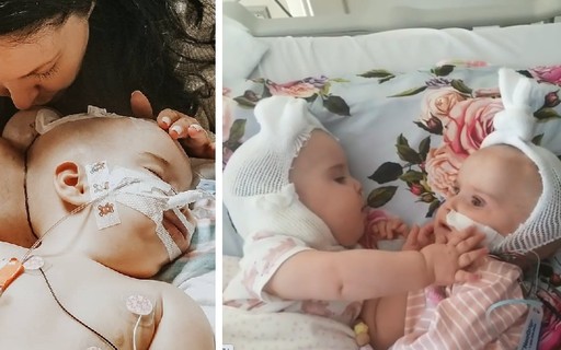 Pais compartilham imagens de siamesas separadas após cirurgia de 24 ...