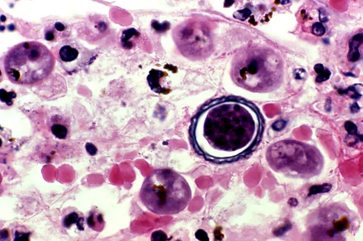 Expansão de ameba 'comedora de cérebros' pelos EUA pode ser ...