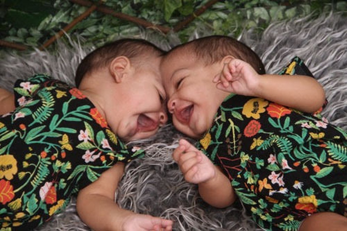 'Elas são um milagre nas nossas vidas', diz mãe de gêmeas siamesas ...
