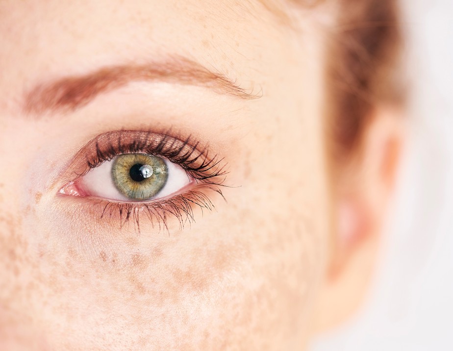 Guia definitivo das olheiras: conheça os diferentes tipos e saiba como ...