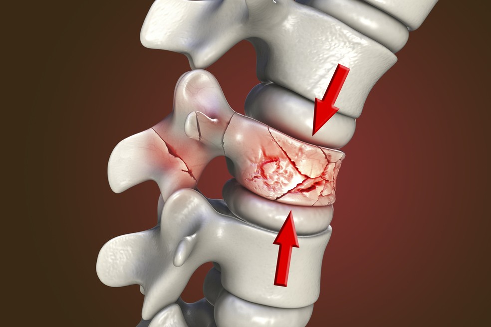 Como Ocorre O Trauma Raquimedular ITC Vertebral