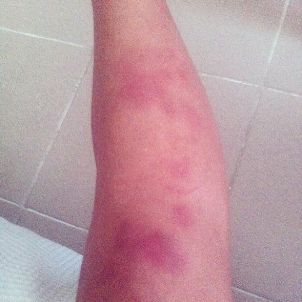 Kelly Medeiros mostra perna machucada após desfiles de Carnaval - Quem ...