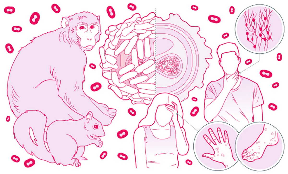 Varíola dos macacos: dos sintomas ao tratamento, tudo que você precisa ...