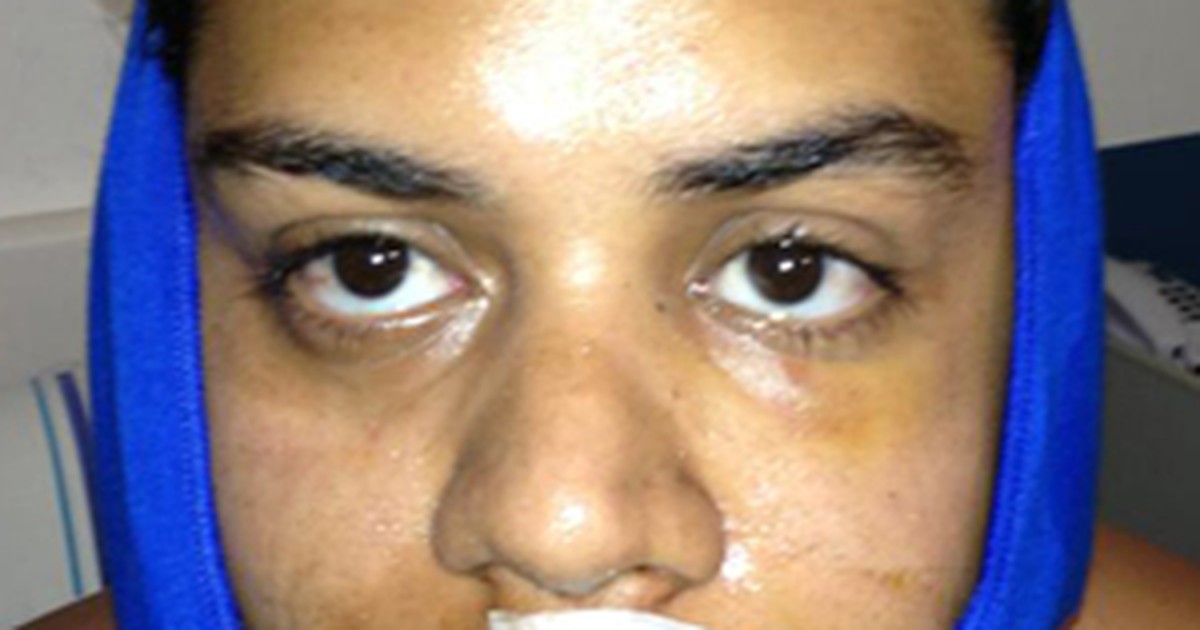 G1 - Jovem com mandíbula quebrada em briga de trânsito passa por ...