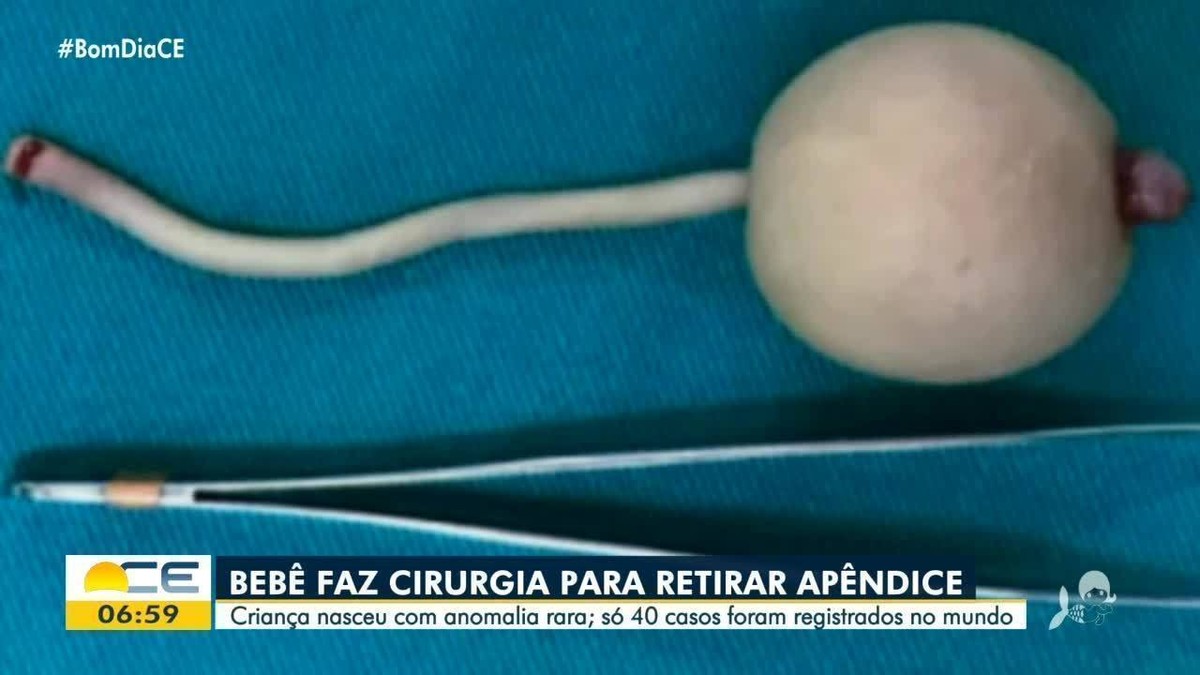 Cauda humana em bebê no Ceará tem apenas 40 casos similares registrados ...