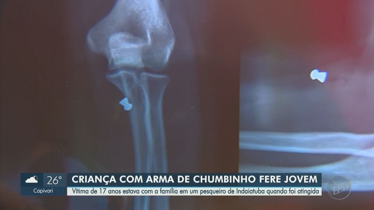 Adolescente Tem Bala Alojada Perto De Artéria Após Ser Atingida Por