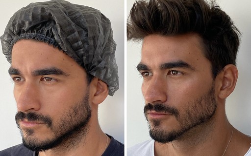 Ex Bbb Gui Napolitano Mostra Antes E Depois De Harmonização Facial