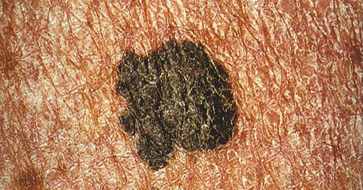 Bem Estar - Número de pintas no braço pode sinalizar propensão a câncer ...