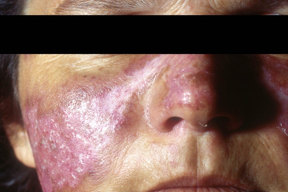 Lúpus Eritematoso Sistêmico: o que é, sintomas, diagnóstico e ...