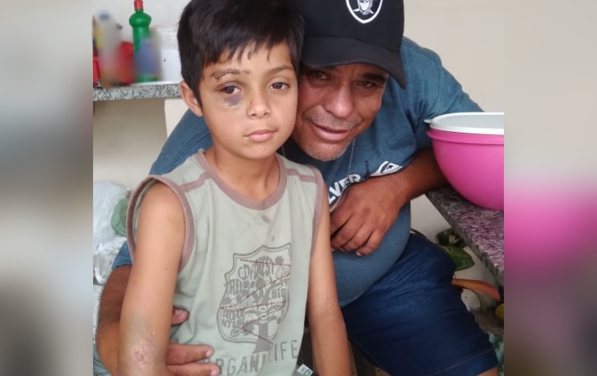 Menino atropelado por carro após cair de bicicleta recebe alta: 'Milagre' | Itapetininga e ...