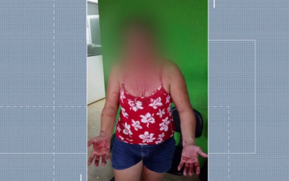 Marido é Preso Suspeito De Morder E Arrancar Parte Do Lábio Da Mulher