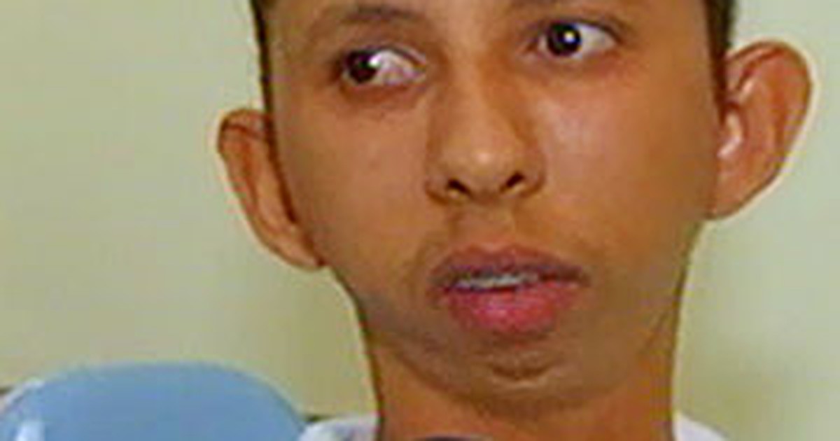 G1 - Jovem que não possui queixo faz 3ª cirurgia de reparação em Cuiabá ...