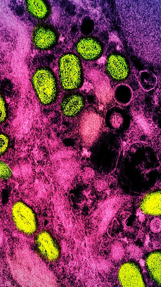 Saiba como a humanidade venceu a varíola, primeiro vírus erradicado