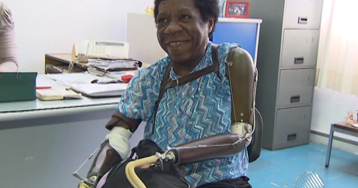 G1 - Com dois braços amputados, mulher supera dificuldades com próteses ...