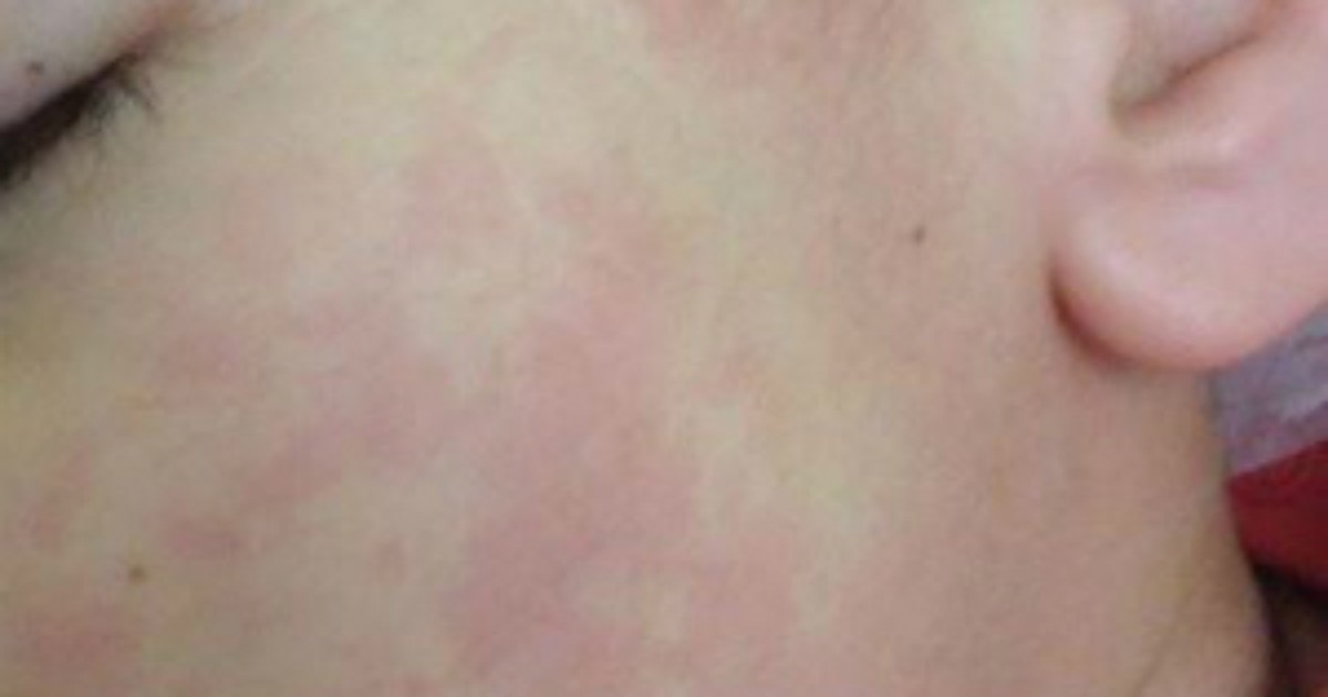 G1 - Criança vai parar em hospital após 48 picadas de formiga em escola ...