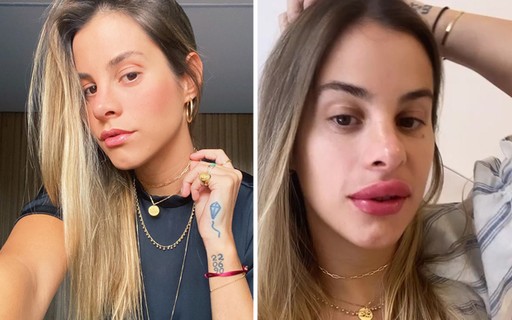 Shantal mostra boca inchada após procedimento: "Não é filtro" - Quem ...