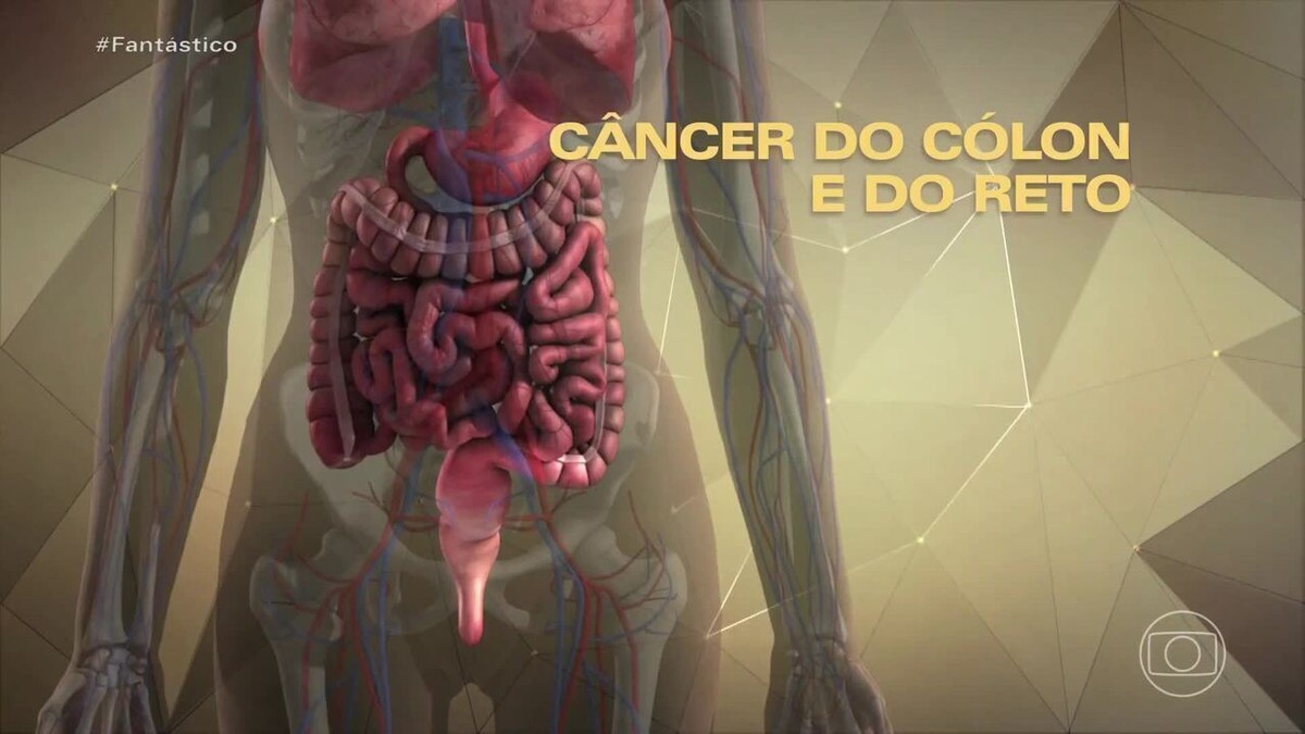 Saiba Como é Feito O Diagnóstico Do Câncer De Intestino Fantástico G1