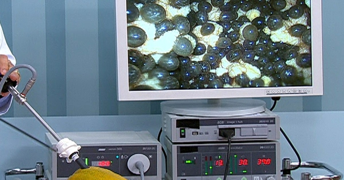 Bem Estar - Cirurgia bariátrica deve ser a última opção para quem ...