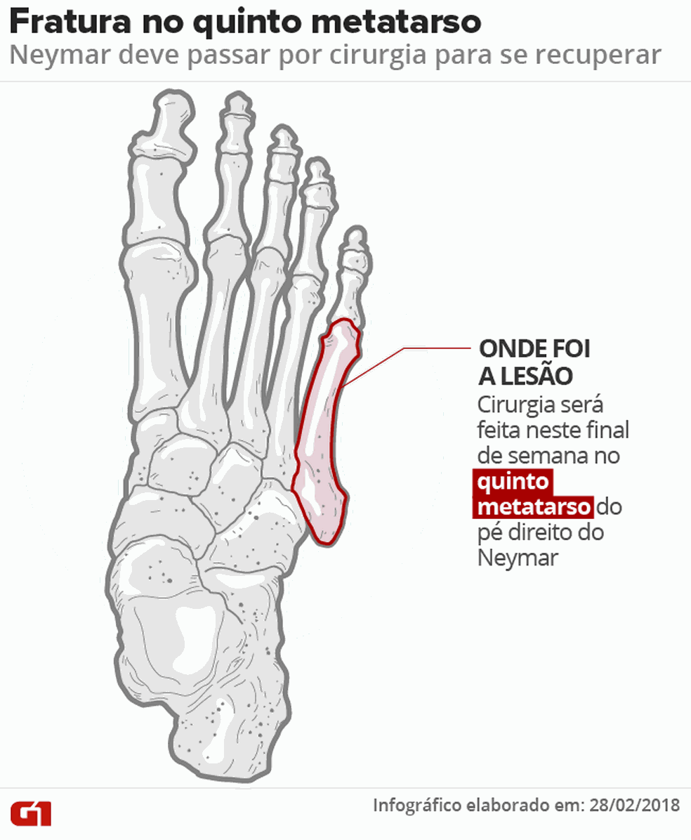 Entenda a lesão de Neymar e por que o atacante do PSG vai passar por ...