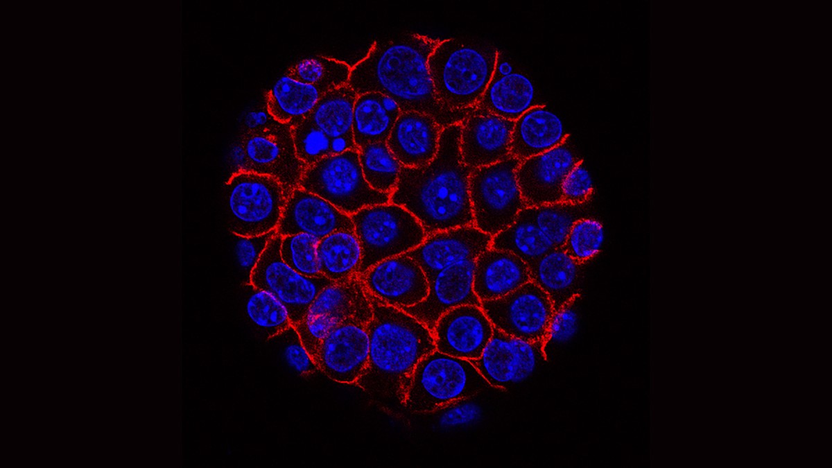Câncer de pâncreas muda a forma como se alimenta para proliferar no ...