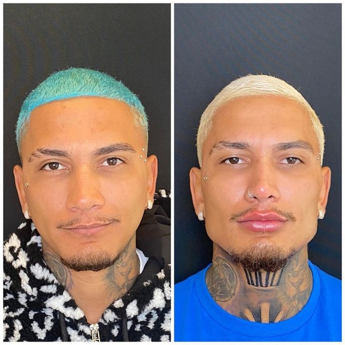Dynho Alves mostra antes e depois de harmonização facial | Celebridades ...