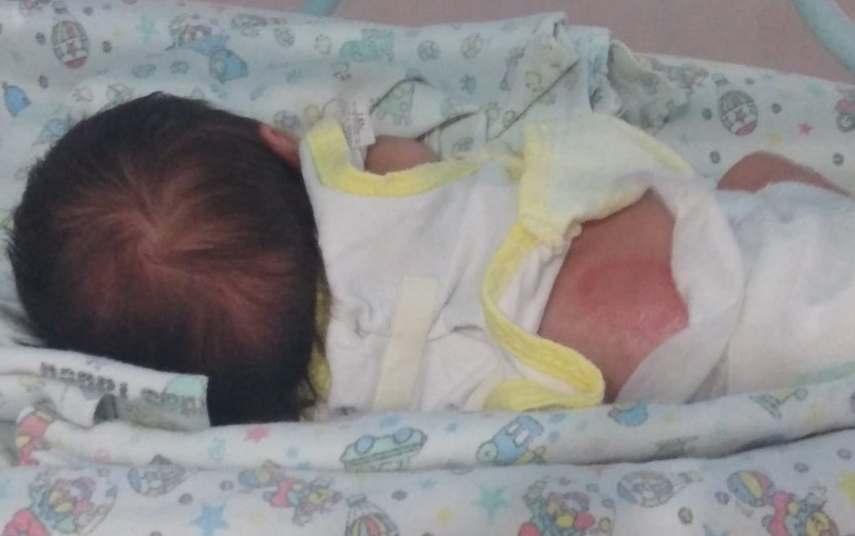 Polícia ainda aguarda laudo para definir o que causou queimadura em ...