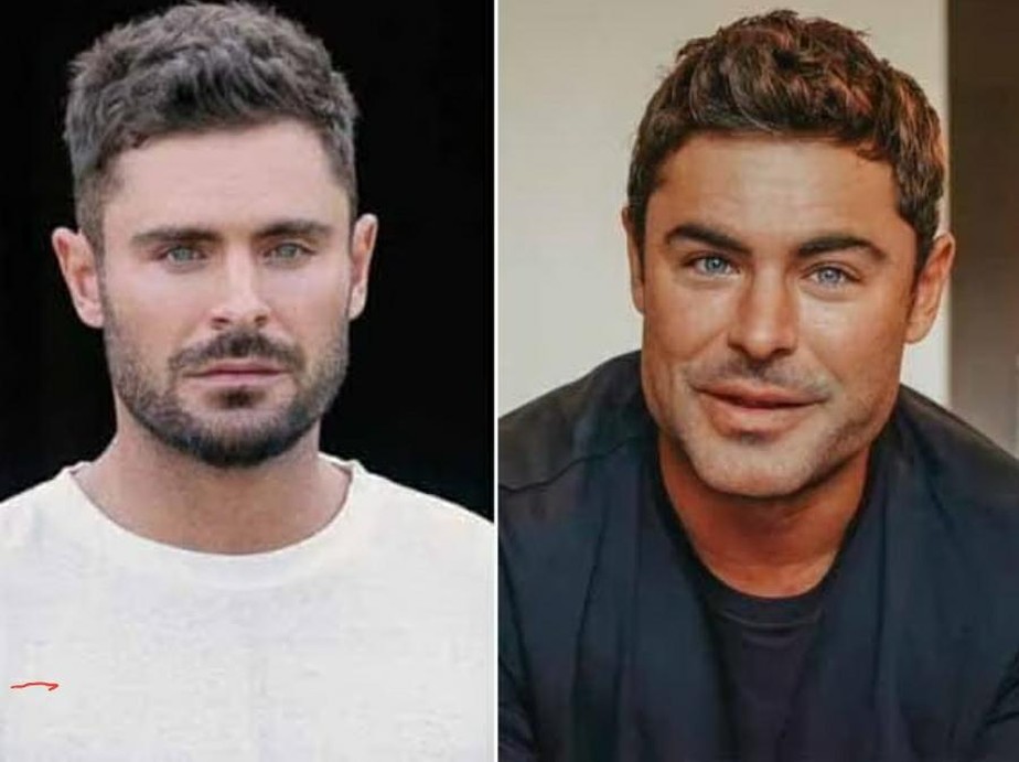 Fratura na mandíbula: entenda a mudança no rosto do ator Zac Efron ...