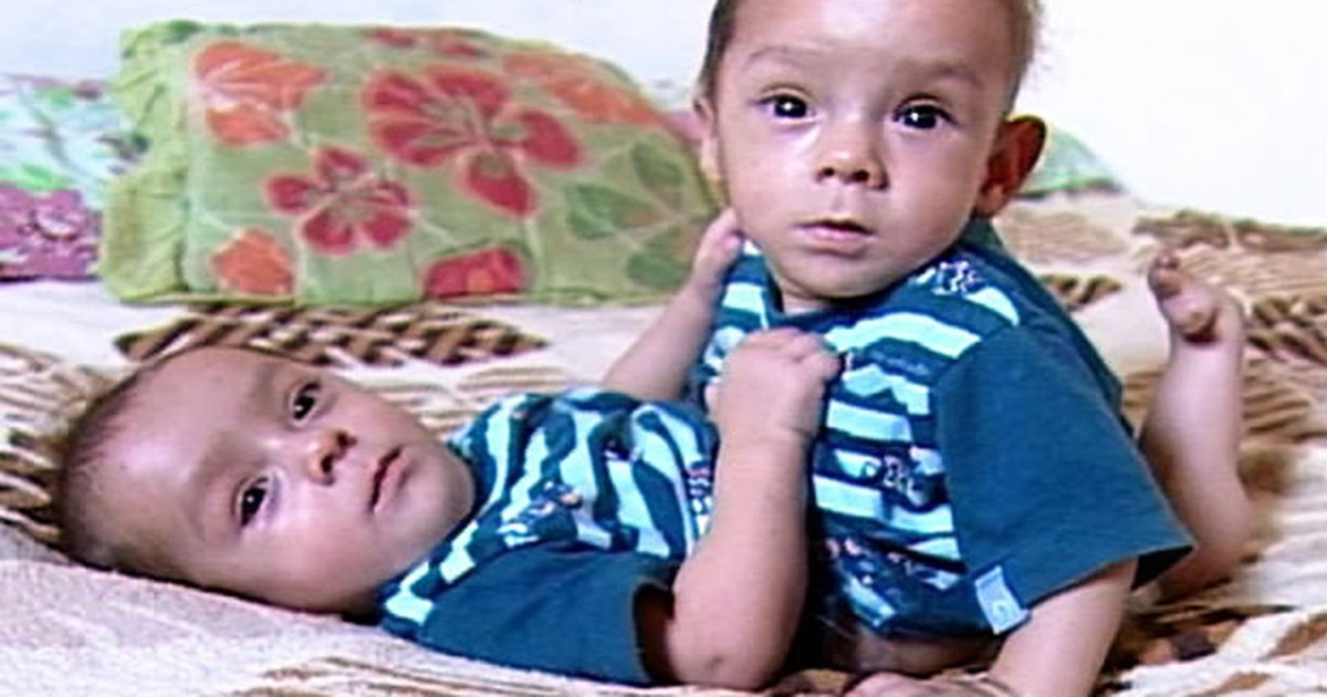 G1 - Gêmeos siameses de MT unidos pelo abdômen fazem cirurgia de ...