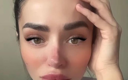 Preenchimento Labial Cirurgião Plástico Esclarece Dúvidas Revista
