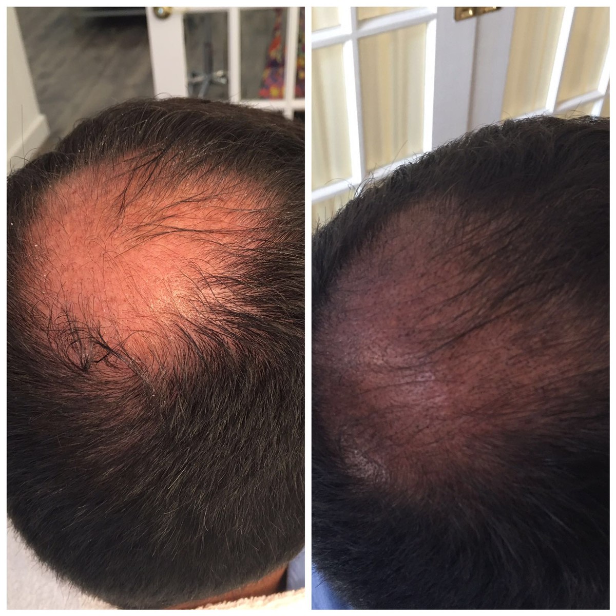 Ser careca é uma escolha | Estética Avançada | G1