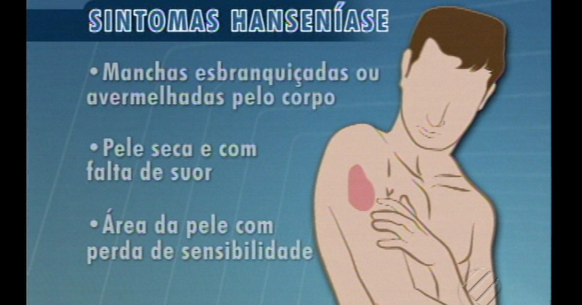 G1 - Especialista tira dúvidas sobre o tratamento da hanseníase ...