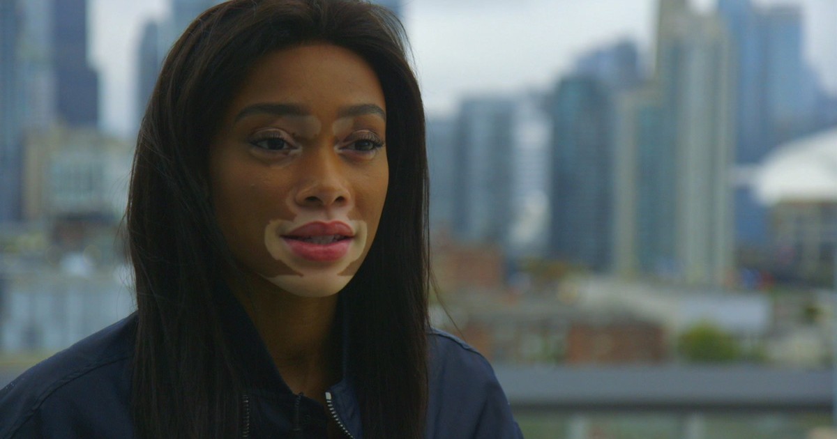 Bem Estar - 'Minha pele não me define': a top model com vitiligo que ...