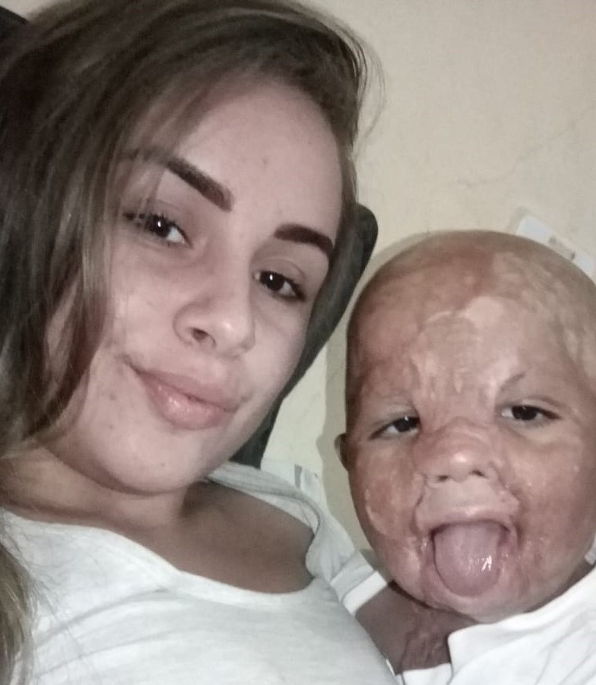 Menino com 100% do rosto queimado arrecada R$ 40 mil para 'virar' herói ...