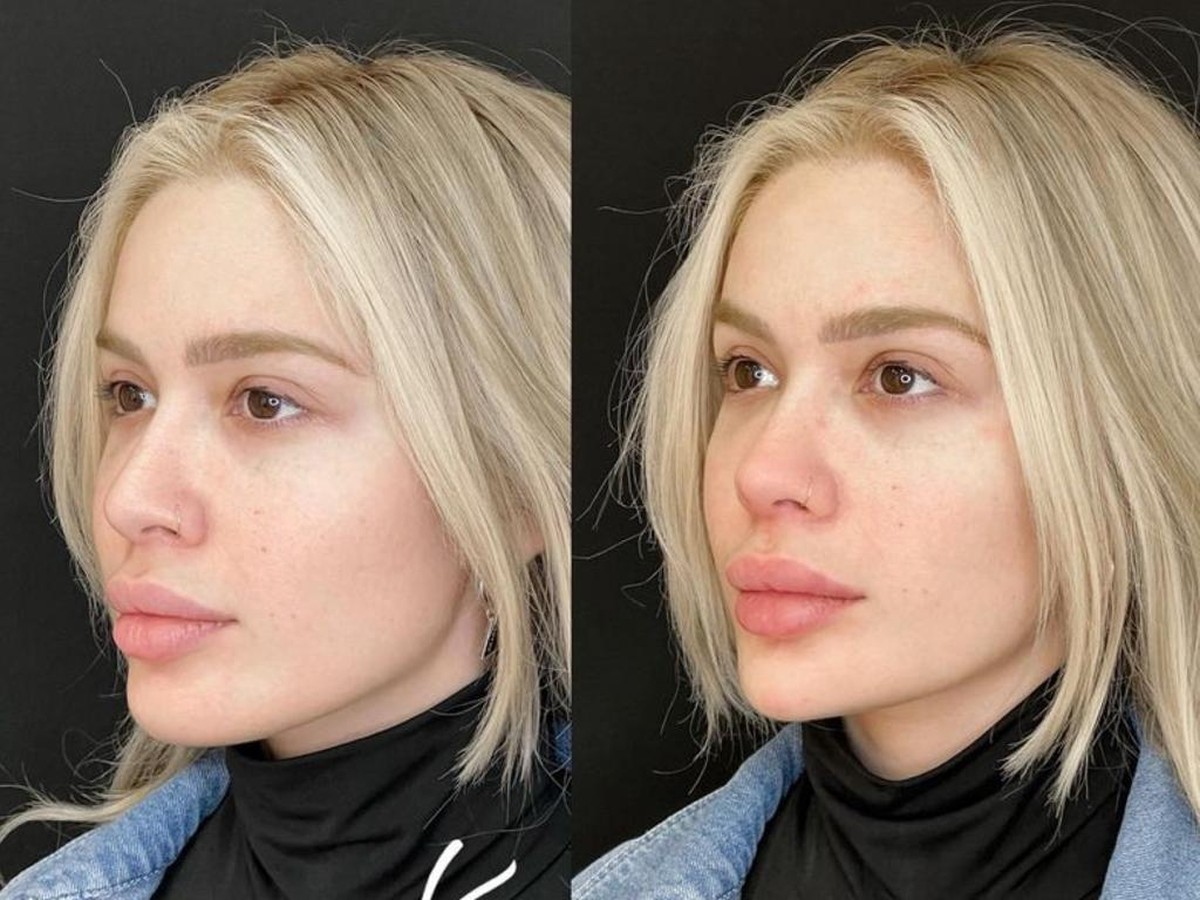 Karoline Lima tem dia de beleza e mostra resultado de procedimentos no rosto | Notícias | Quem