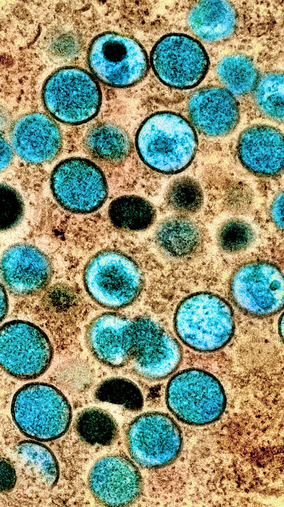 Varíola dos macacos: lesões diferentes na pele são novo sintoma da ...