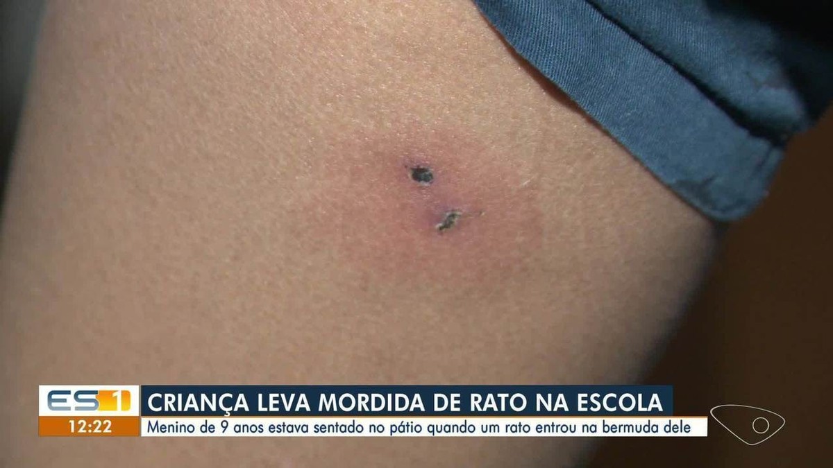 Rato entra em bermuda e morde menino em escola no ES | Espírito Santo | G1