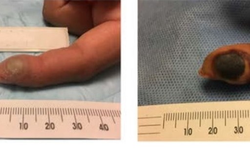 Funcionária se machuca e contrai vírus semelhante ao da varíola ...