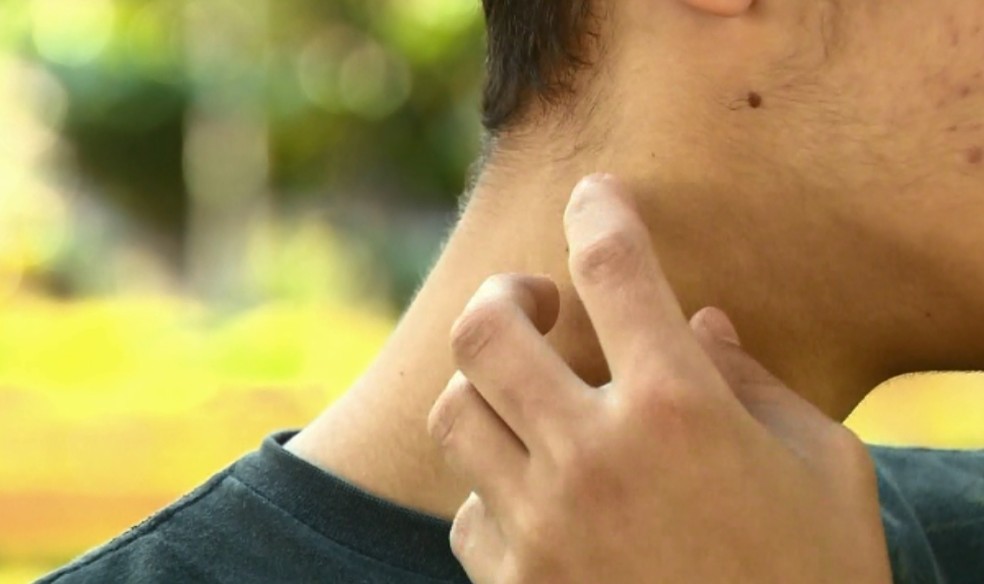 Com cinco surtos de caxumba informados em 2017, Sesa diz que faixa ...