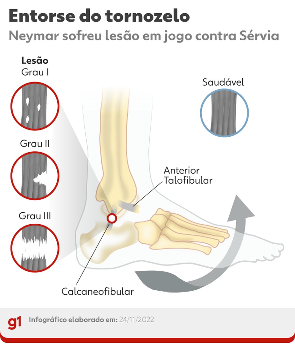 Neymar sofre entorse no tornozelo: entenda o que é a lesão - Sobral Online