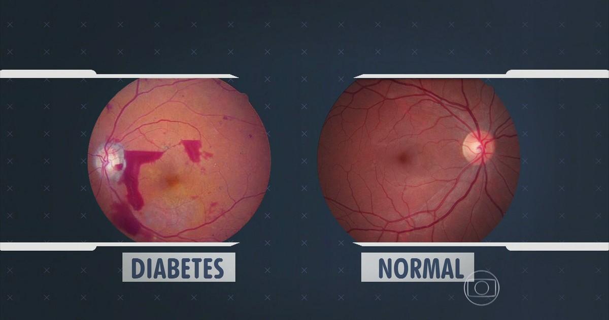 Bem Estar - Exame de fundo de olho consegue detectar diversos tipos de ...