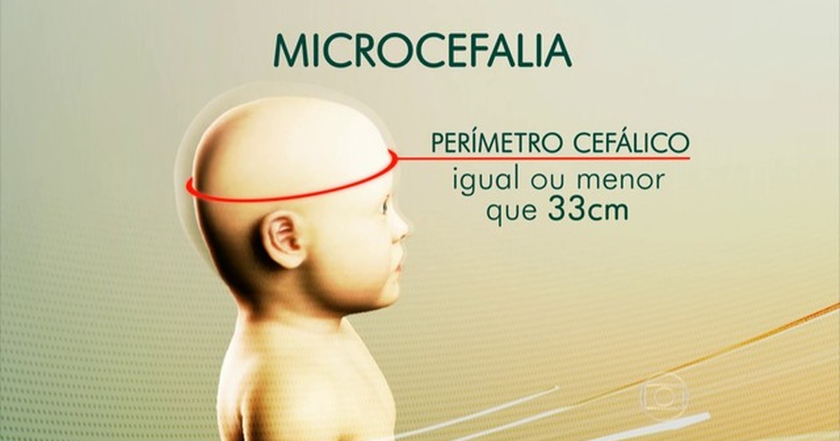G1 - Ministério da Saúde investigará caso de microcefalia associado à ...