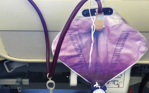 Urina de paciente internada em hospital fica com coloração roxa ...