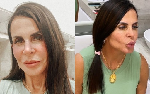 Gretchen celebra resultado de nova harmonização facial - Quem | QUEM News